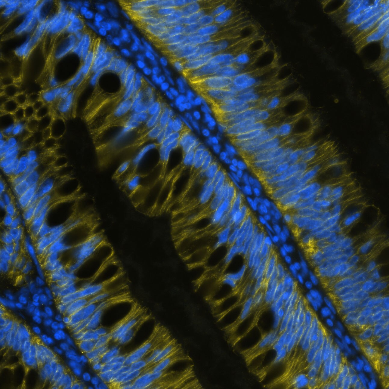 Detection of beta-Catenin in Human Colon Cancer via Multiplex ...